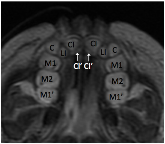 CT and MR Appearance of Teeth: Analysis of Anatomy and Embryology and ...