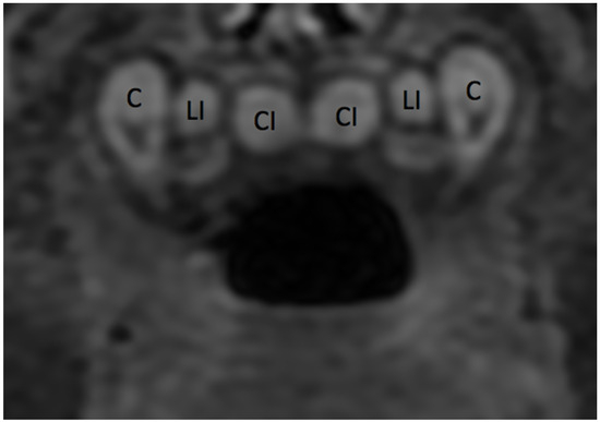 CT and MR Appearance of Teeth: Analysis of Anatomy and Embryology and ...