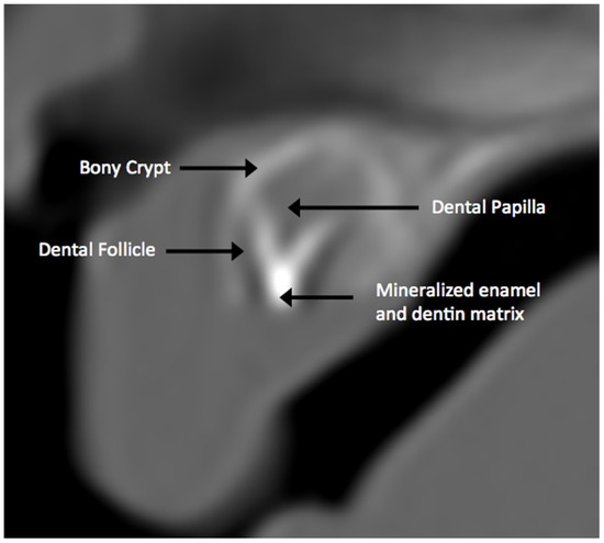 CT and MR Appearance of Teeth: Analysis of Anatomy and Embryology and ...