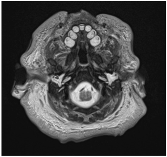 CT and MR Appearance of Teeth: Analysis of Anatomy and Embryology and ...