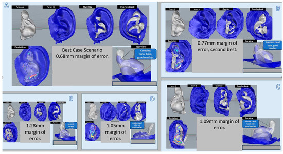 A Novel Ear Impression-Taking Method Using Structured Light Imaging and ...