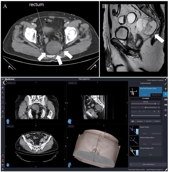 Stereotactic Navigation-Assisted Laparoscopic Resection of Challenging ...