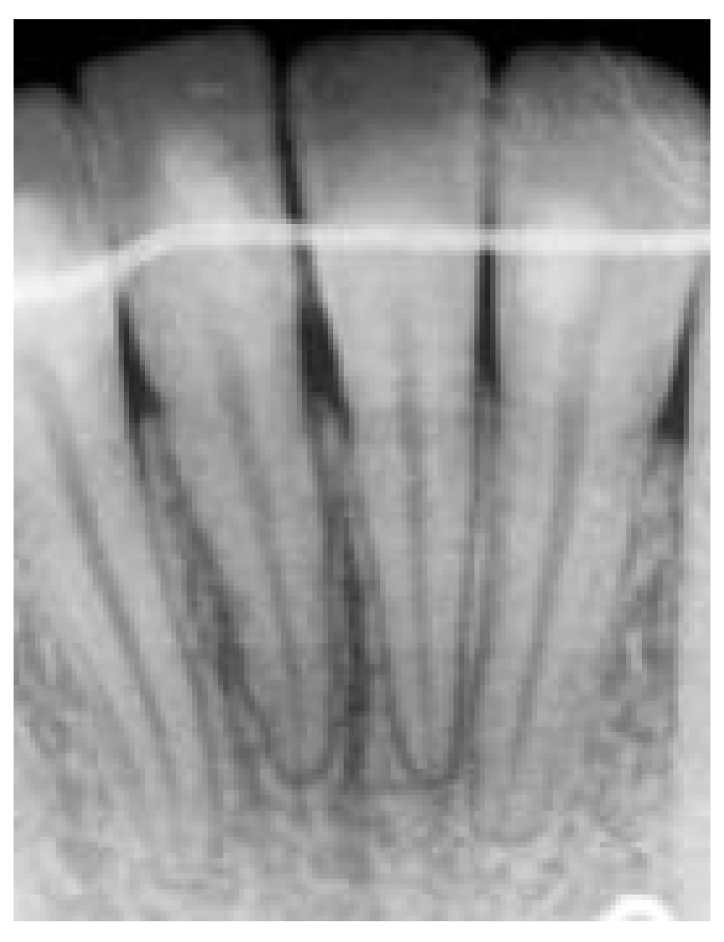 Diagnostic Accuracy of Cone Beam Computed Tomography and Periapical ...