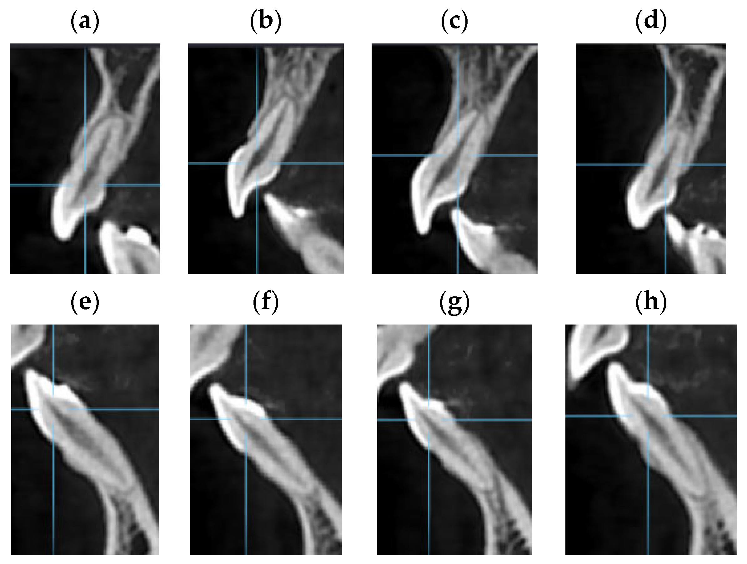 Diagnostic Accuracy of Cone Beam Computed Tomography and Periapical ...