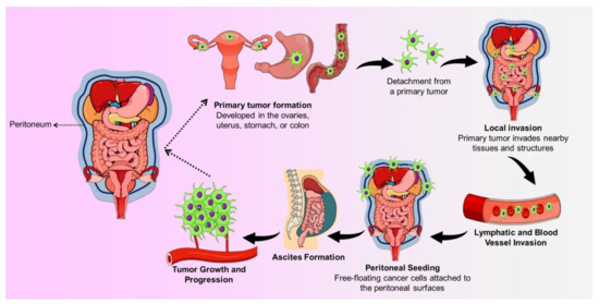 Peritoneal Carcinomatosis of Malignant Gynecological Origin: A ...
