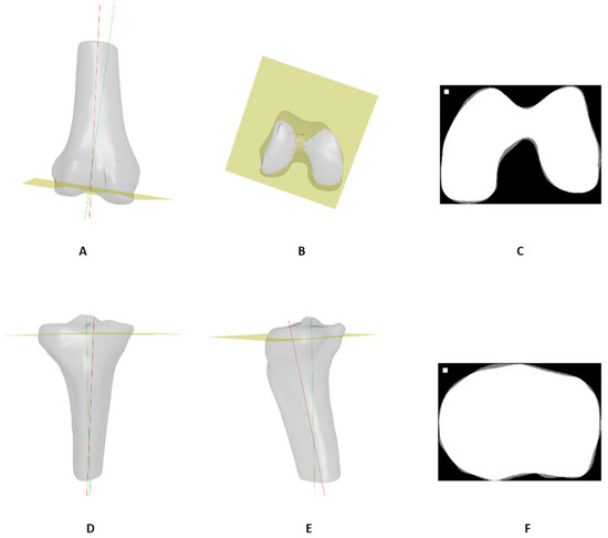 Validating a Novel 2D to 3D Knee Reconstruction Method on Preoperative ...