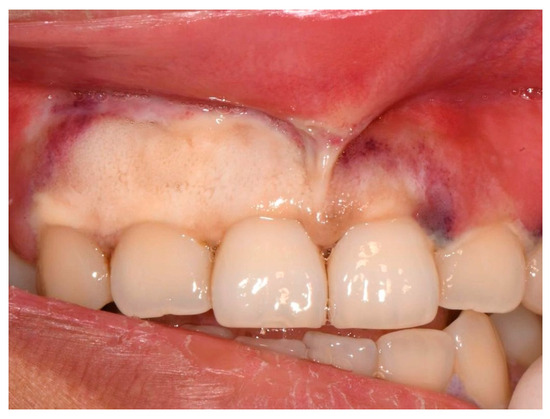Gingival Necrosis Related to Sepsis-Induced Agranulocytosis Due to ...