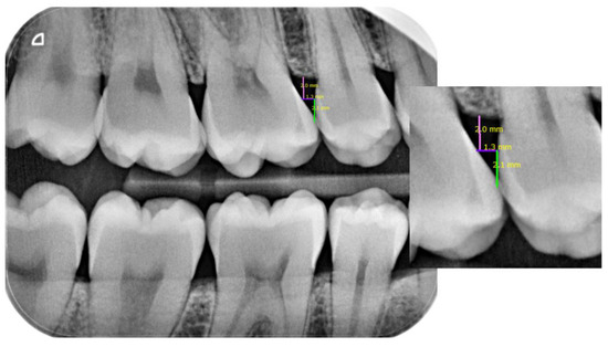New Technique for Wedge Selection in Direct Class II Restorations: A ...