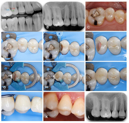 New Technique for Wedge Selection in Direct Class II Restorations: A ...