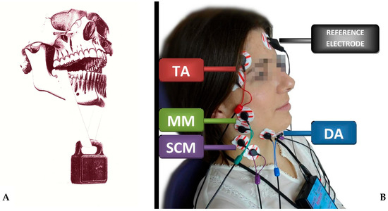 Surface Electromyography in Dentistry—Past, Present and Future