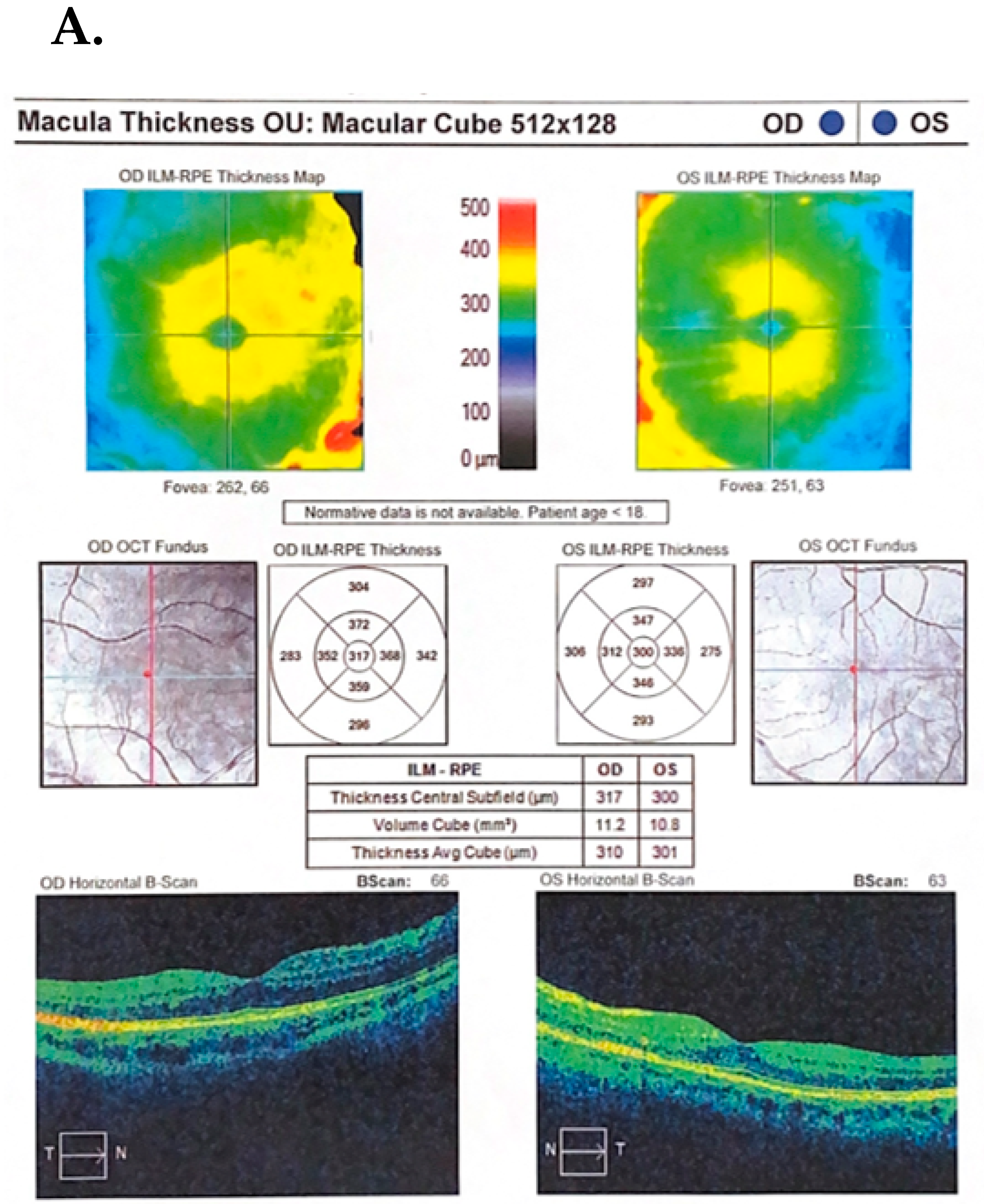 Isolated Depo-Medrol Administration under Tenon’s Capsule for Post ...