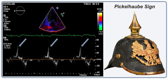 JCM | Free Full-Text | Arrhythmic Mitral Valve Prolapse and Sports Activity: Pathophysiology ...