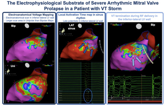 JCM | Free Full-Text | Arrhythmic Mitral Valve Prolapse and Sports ...