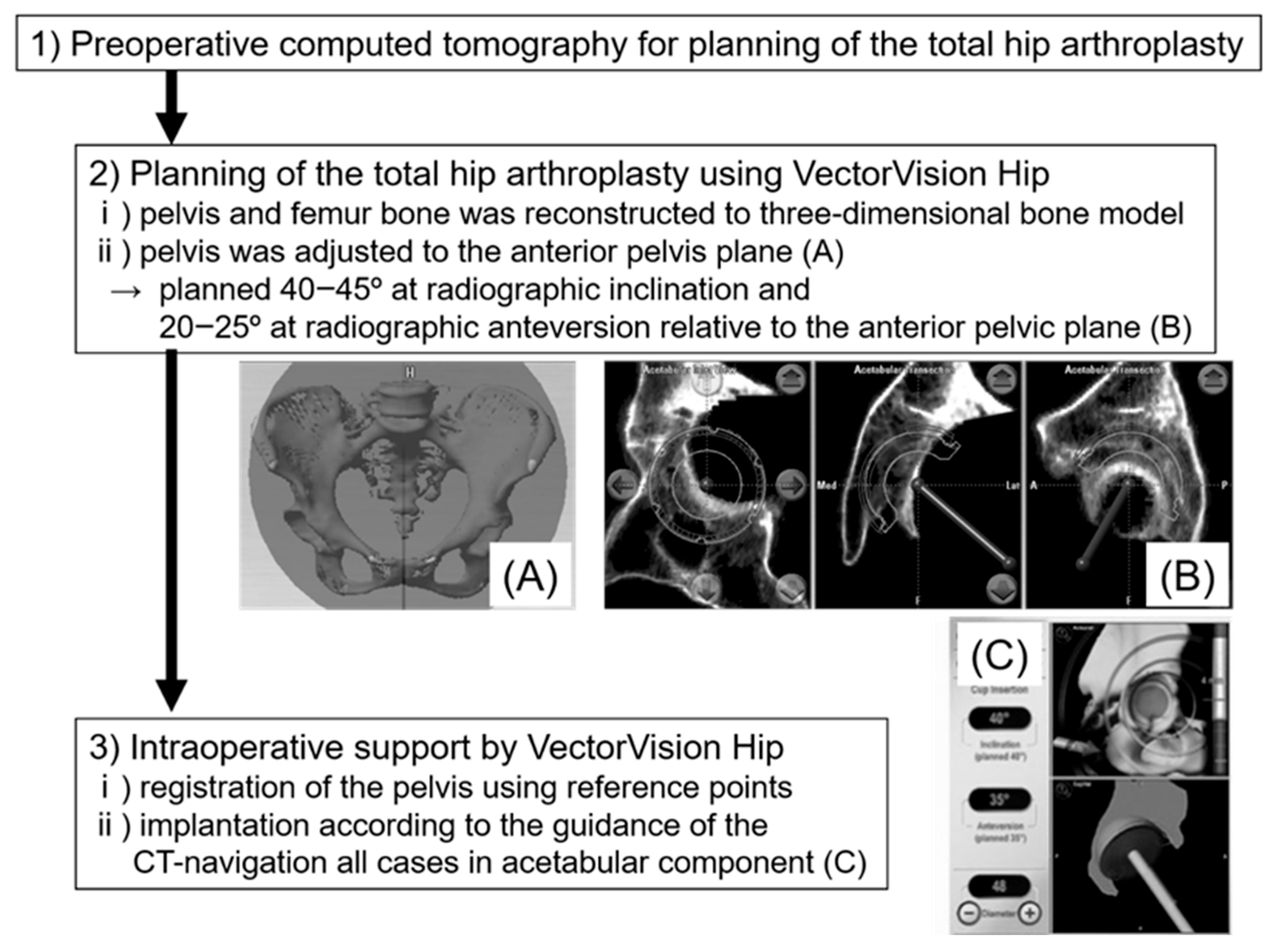 The Long-Term Efficacy of Computed Tomography-Navigated Total Hip ...