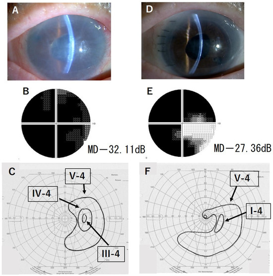 Changes in the Visual Field Test after Descemet Stripping Automated ...