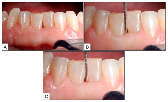 Effectiveness of Topical Oxygen Therapy in Gingivitis and Periodontitis ...