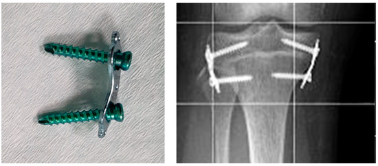 JCM | Free Full-Text | The Influence of Temporary Epiphysiodesis of the ...