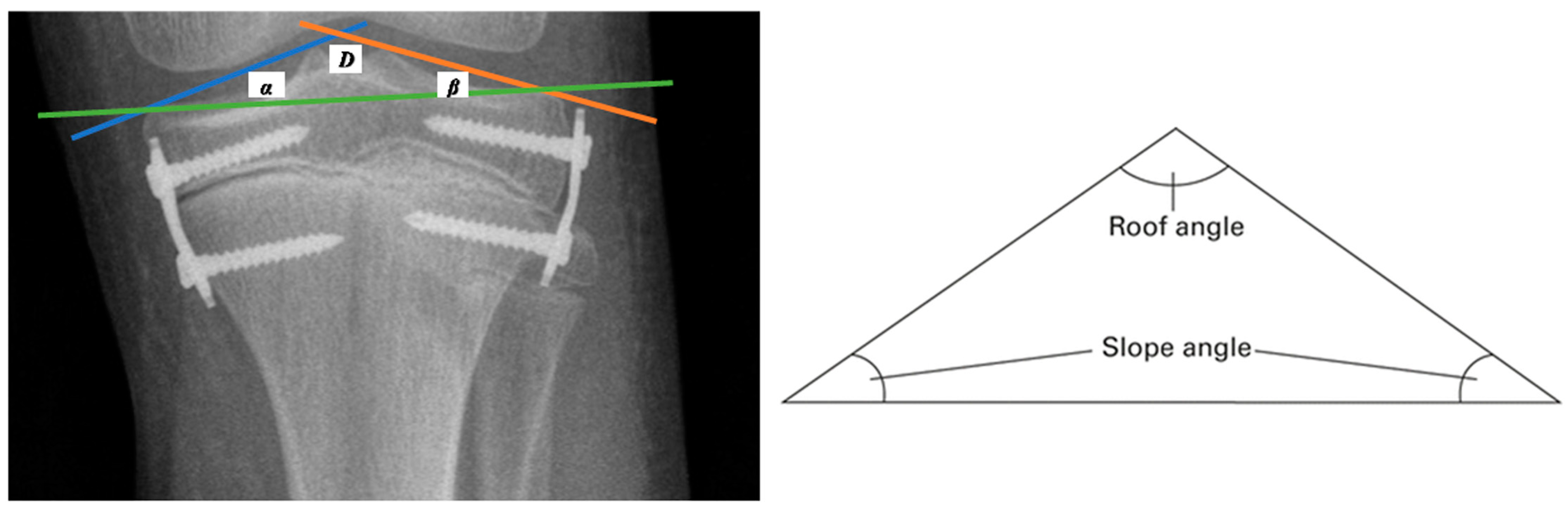 JCM | Free Full-Text | The Influence of Temporary Epiphysiodesis of the ...