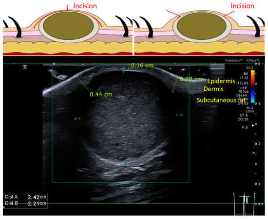 Evaluation of Esthetic Results after Mass Removal with Elliptical Skin ...
