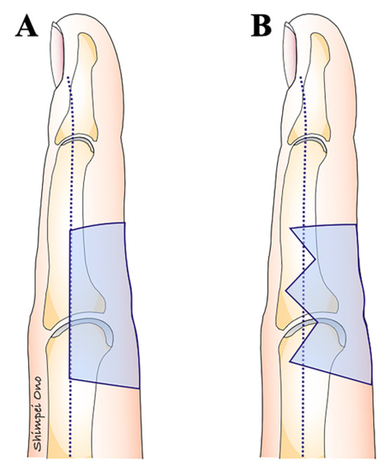 Management of Scar Contractures of the Hand—Our Therapeutic Strategy ...