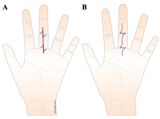 Management of Scar Contractures of the Hand—Our Therapeutic Strategy ...