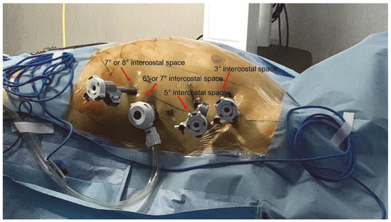 Robotic-Assisted Epicardial Hybrid Ablation and Left Appendage Closure in Persistent Atrial ...