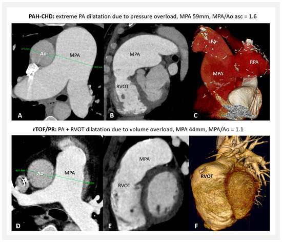 Pulmonary Artery Dilatation Due to Pressure or Volume Overload in ...