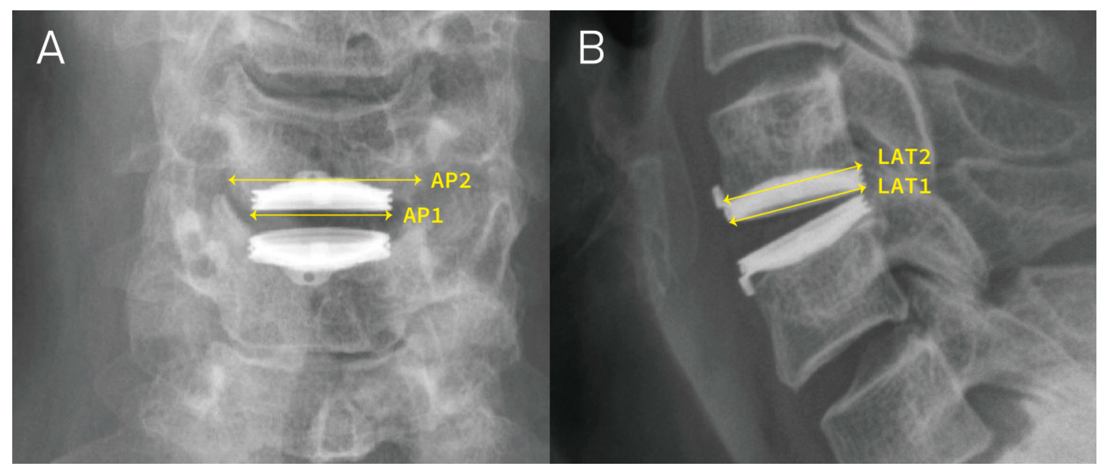 Risk Factors for Cervical Disc Arthroplasty Subsidence with Bryan Disc ...