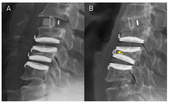 Risk Factors for Cervical Disc Arthroplasty Subsidence with Bryan Disc ...