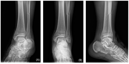 The Outcomes of Mini-Plate Fixation for Unstable Wagstaffe Tubercle ...