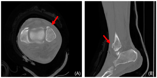 The Outcomes of Mini-Plate Fixation for Unstable Wagstaffe Tubercle ...