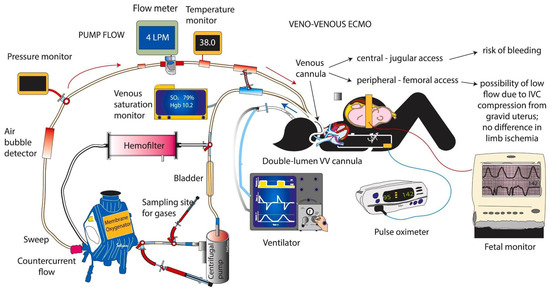 Extra-Corporeal Membrane Oxygenation in Pregnancy