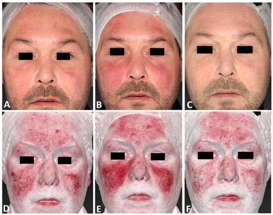 Effective Treatment of Rosacea and Other Vascular Lesions Using Intense ...