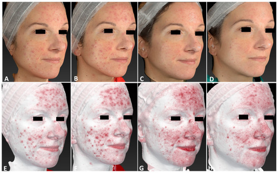 Effective Treatment of Rosacea and Other Vascular Lesions Using Intense ...