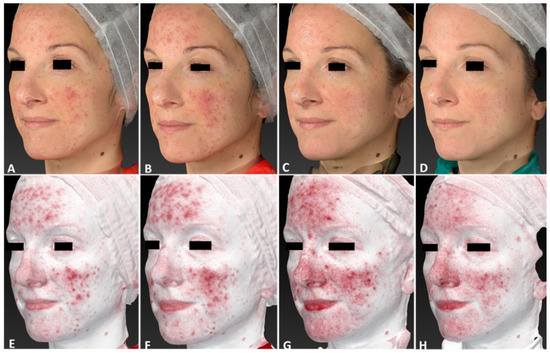 Effective Treatment of Rosacea and Other Vascular Lesions Using Intense ...