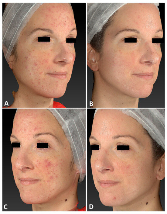 Effective Treatment of Rosacea and Other Vascular Lesions Using Intense ...