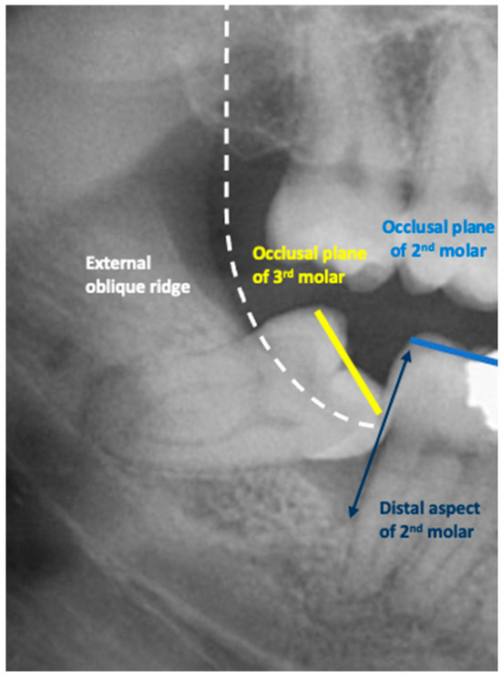 JCM | Free Full-Text | Radiographic Detection Rate of Distal Surface ...