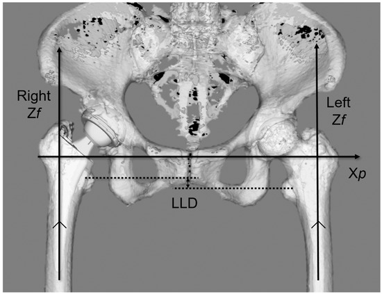 The Sum of the Leg Length Discrepancy and the Difference in Global ...