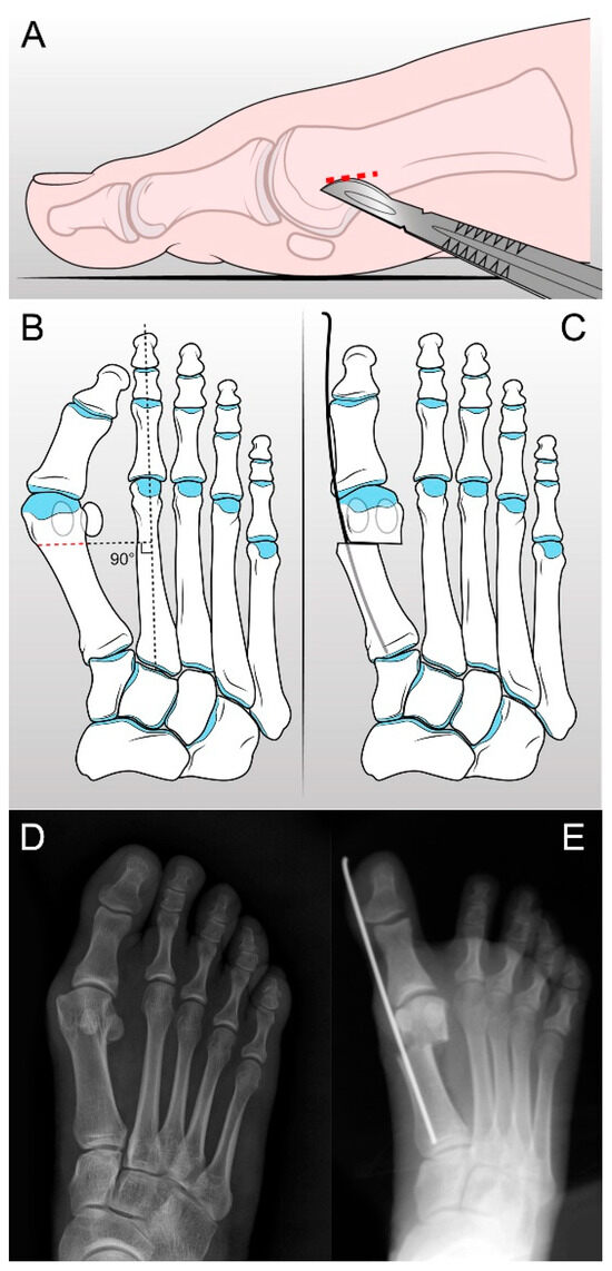 Hallux Valgus Plantar Pressure Distribution before and after a Distal ...