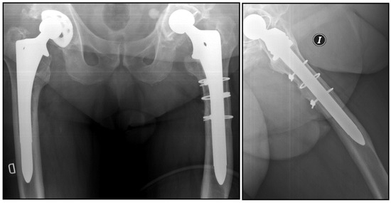 Comparison of Cylindrical and Tapered Stem Designs for Femoral Revision ...