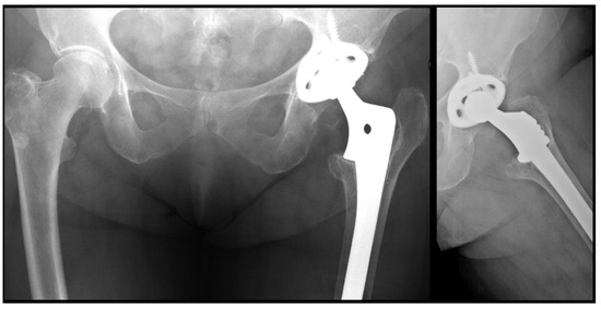 Comparison of Cylindrical and Tapered Stem Designs for Femoral Revision ...