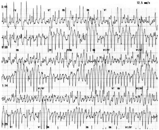 Catecholaminergic Polymorphic Ventricular Tachycardia: Clinical ...