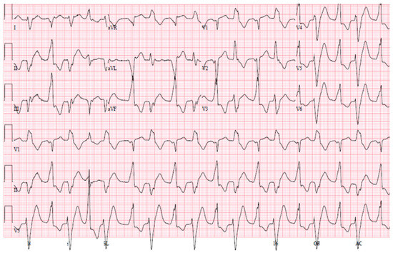 Catecholaminergic Polymorphic Ventricular Tachycardia: Clinical ...
