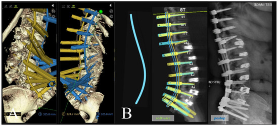 Preoperative Robotics Planning Facilitates Complex Construct Design in ...