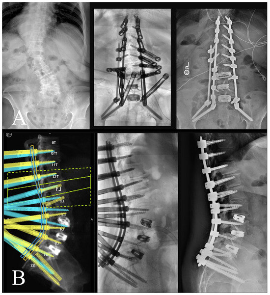 Preoperative Robotics Planning Facilitates Complex Construct Design in ...