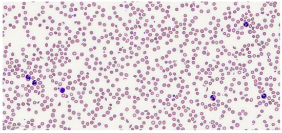 Hypertensive Emergency with Thrombotic Microangiopathy or TTP? A Case ...