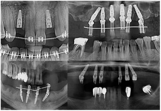 Early Implant Failure: A Meta-Analysis of 7 Years of Experience