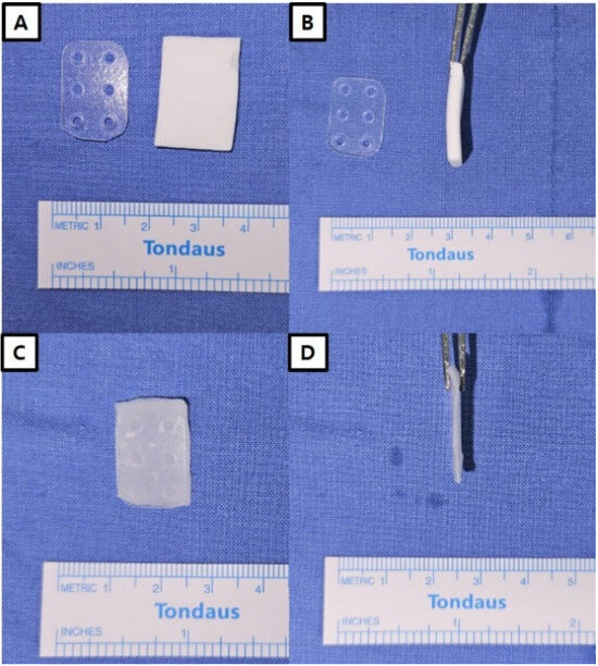 Reconstruction of Orbital Wall Fractures with a Combination of ...