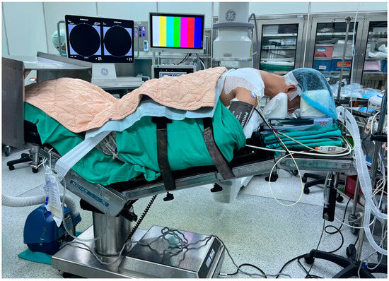 Novel Cervical Endoscopic Unilateral Laminoforaminotomy for Bilateral ...