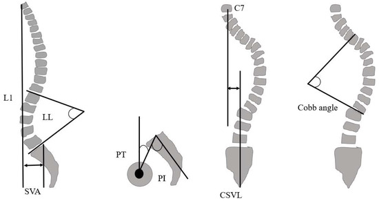 Use of a Triaxial Accelerometer to Measure Changes in Gait Sway and ...